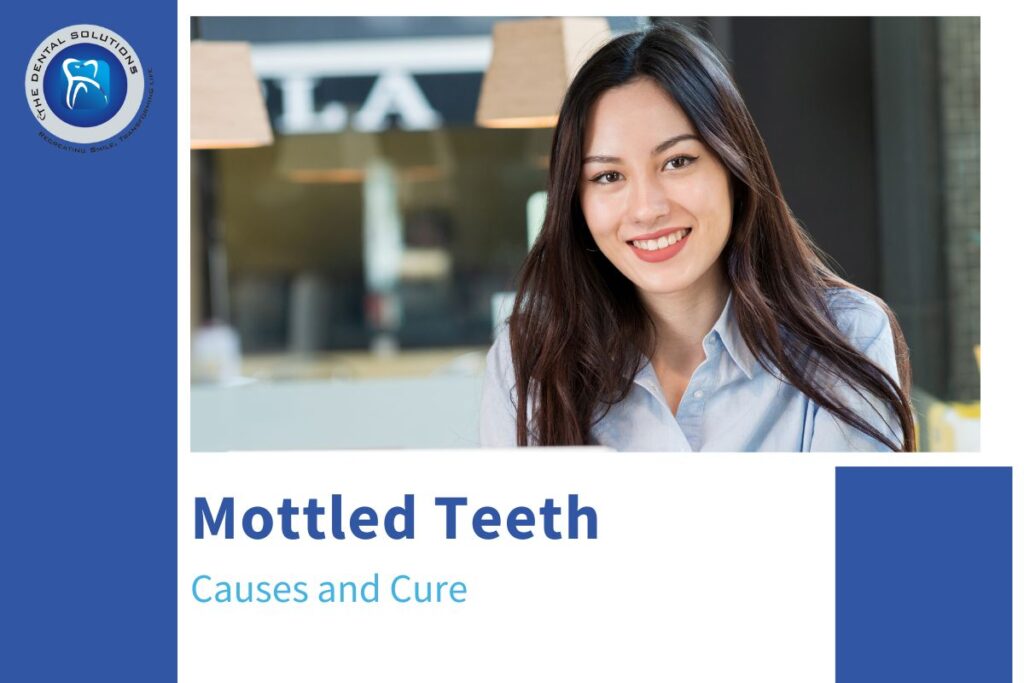 What is mottled teeth - The Dental Solutions